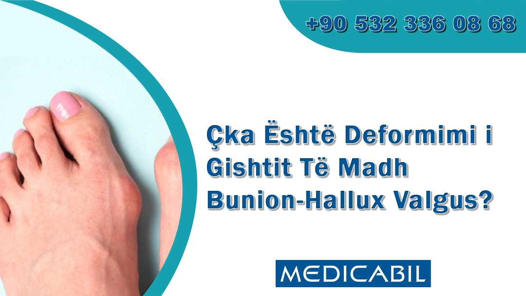 Çka Është Deformimi i Gishtit Të Madh Bunion-Hallux Valgus? | Bursa ...